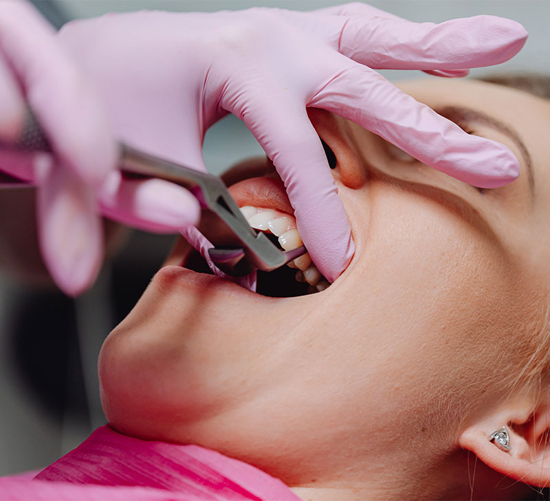 Post Op Tooth Extraction Treatment In Yorba Linda CA Post Op Tooth Extraction Treatment In Yorba Linda CA